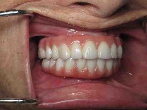 Where Is The Cheapest Place To Have Your Teeth Done Best Of Indianapolis